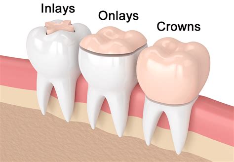 Crowns Vs Onlays Which One Is Right For You The Online Dentist