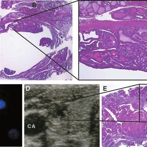 Polymorphous Population Of Lymphocytes And Epithelial Like Cells Seen Download Scientific