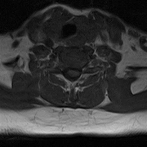 Right Lobe Thyroideal Solitary Nodule The Nodule Is Slightly