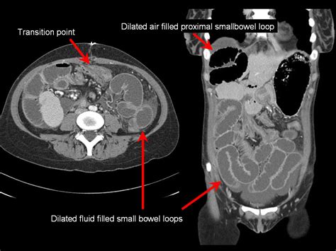 On Call Radiology Emergency Radiology Findings On Call
