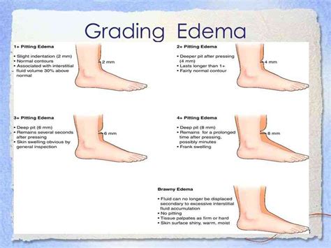 Lower Extremity Edema Grading Scale At Michael Lefroy Blog