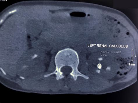 Bilateral Medullary Nephrocalcinosis With Nephrolithiasis A Case