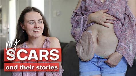 My Scars And Their Stories And Ectopic Rupture Incision 3 Month Update Lets Talk Ibd Youtube