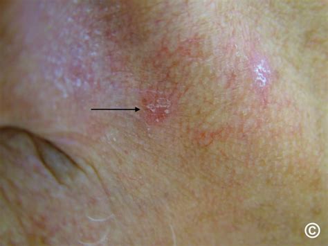 Actinic Keratosis Nose