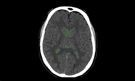 Rtstruct Segmentation Discrepancy Support 3d Slicer Community