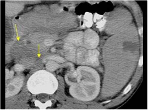 Abdomen And Retroperitoneum 17 Peritoneum Mesentery And Omentum
