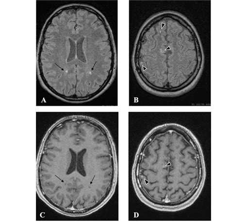 Brain Involvement In Scleroderma A B Axial T2 Flair Magnetic Download Scientific Diagram