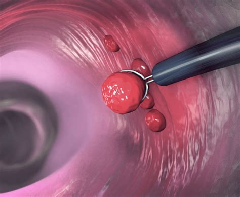 What Is Emr Polypectomy Gastroenterologist In Cape Town Dr Deetlefs