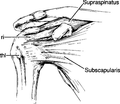 Figure 1 From Isolated Closure Of Rotator Interval Defects For Shoulder