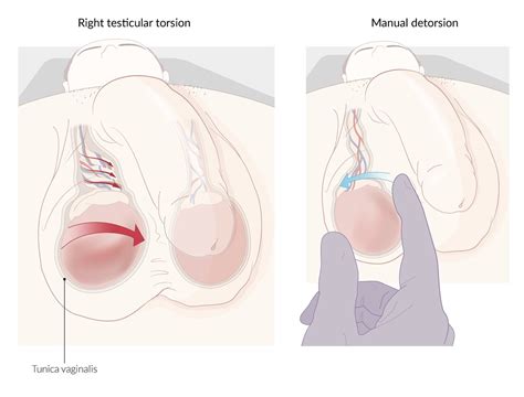Testicular Appendage