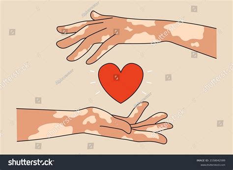 Vitiligo Leprosy Over 1 Royalty Free Licensable Stock Illustrations