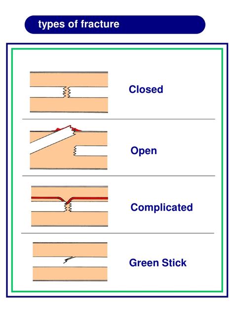 Types Of Fracture First Aid First Aid For Free