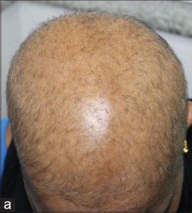 Diffuse Unpatterned Alopecia Causes Symptoms Treatment
