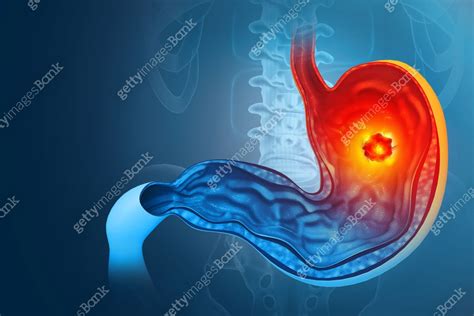 Stomach Cancer Gastric Cancer Symptoms Stages Treatment 3d