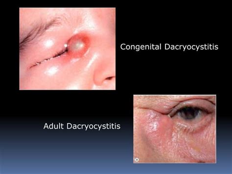 Disorders Of Lacrimal System 2ppt