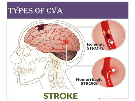 Cva Cerebrovascular Accident Stroke Ppt