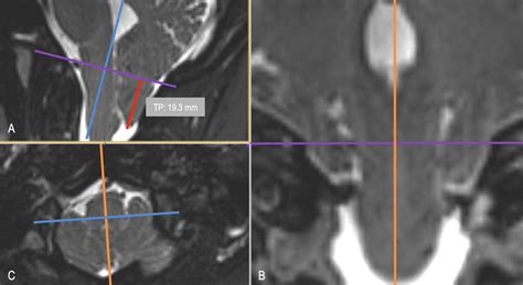 Cerebellar Tonsil Ectopia Measurement In Type I Chiari Malformation Patients Show Poor Inter
