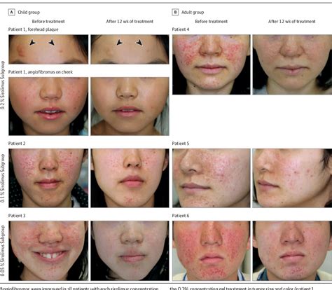 Topical Sirolimus Semantic Scholar