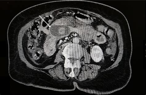 Ct Scan Revealing The Jejunal Gallstone Responsible For Small Bowel