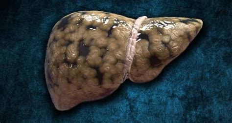 Hepatite C Sintomas Transmissão E Tratamento