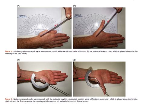 Freely Available Pollexograph Most Reliable Angle Based Method For Measuring Thumb Radial Abduction