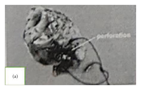 Gall Bladder Specimen A Perforated Tract Marked With A Thread B Download Scientific