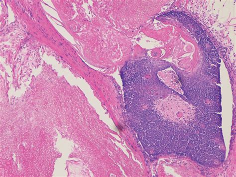 Colossal Pilomatrixoma The Annals Of The Royal College Of Surgeons Of