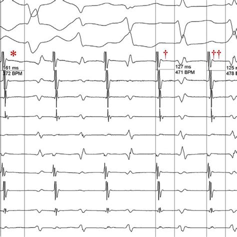QRS Morphology Changed From A Right Bundle Branch Block Pattern To A Download Scientific