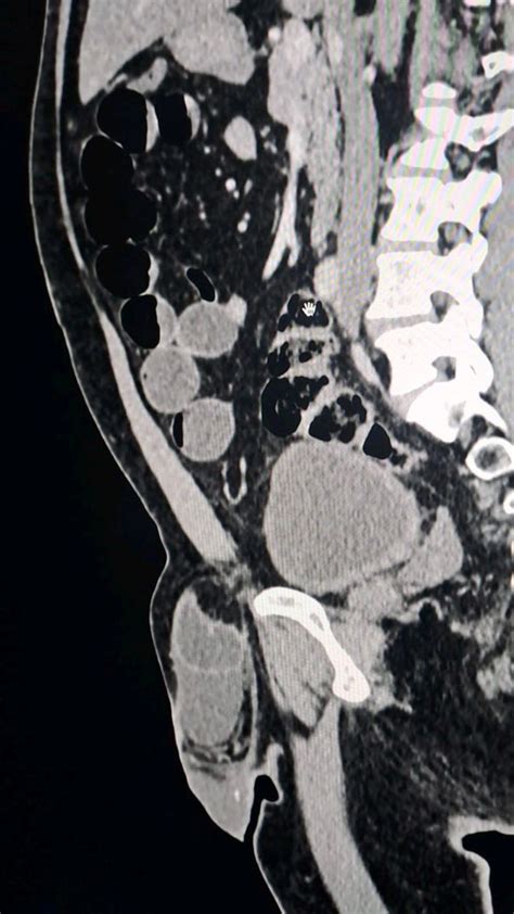 Arun Kumar On Linkedin Concurrent Strangulated Right Inguinal Hernia