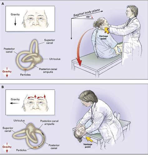 Canalith Repositioning Procedure Diagram Epley Maneuver Canalith