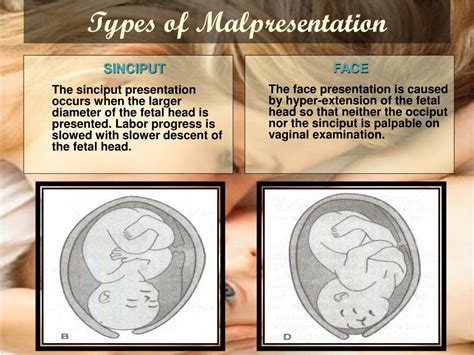 Ppt Types Of Malpresentation Powerpoint Presentation Free Download