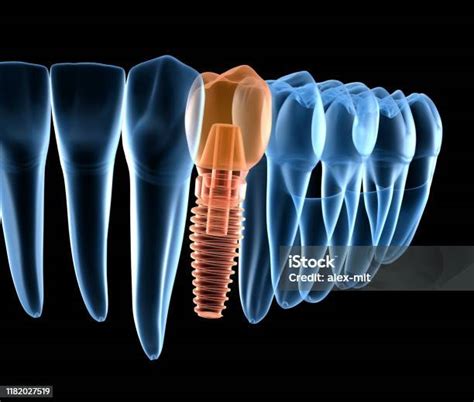 임플란트 엑스레이 보기로 조발치 치아 회복 인간의 치아와 의치 개념의 의학적으로 정확한 3d 그림 건강관리와 의술에 대한 스톡 사진 및 기타 이미지 Istock