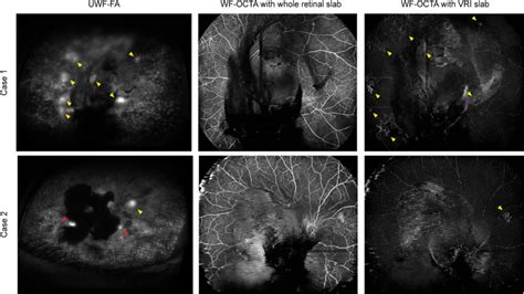 Practical Utility Of Widefield Oct Angiography To Detect Retinal Neovascularization In Eyes With