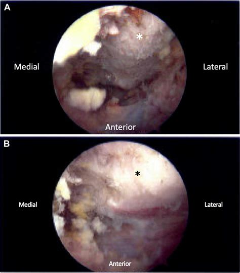 Outcomes After Arthroscopic Scapulothoracic Bursectomy For The