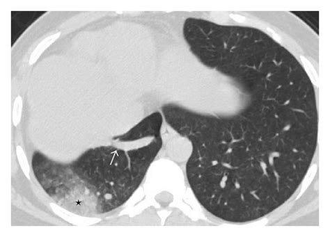 Ct Axial Image Depicts Sequestration As Patchy Consolidation At Right