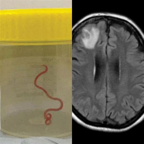 Surgeons Find Worm Living In Womans Brain In Worlds First Case After
