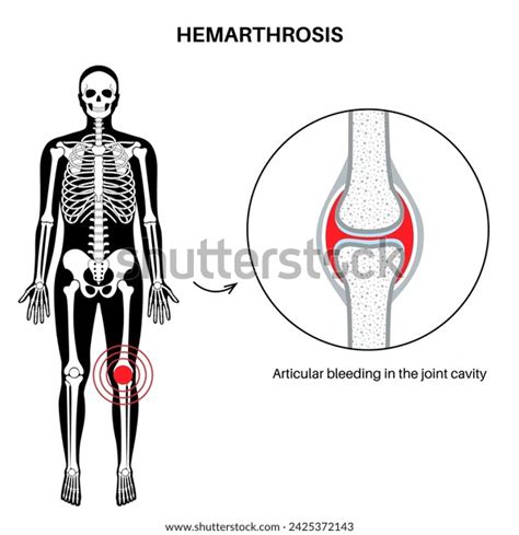 Hemarthrosis Disease Medical Poster Bleeding Inside Stock Vector