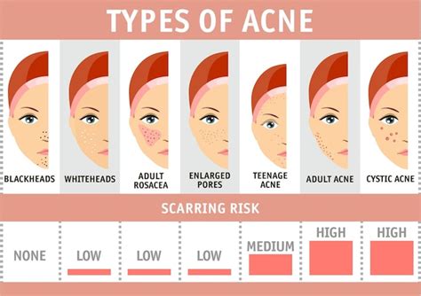 Types Of Acne Chart