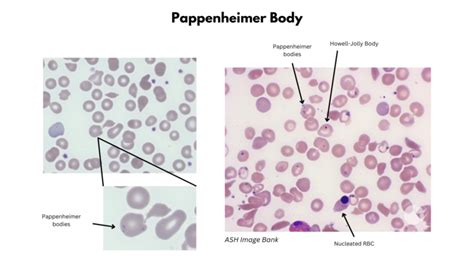 Red Cell Inclusions • The Blood Project