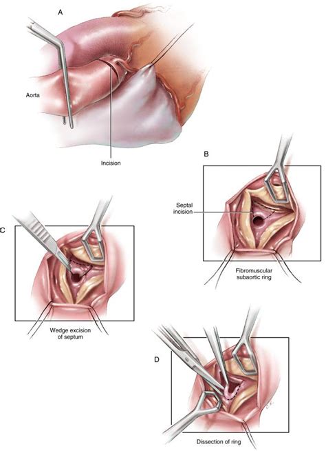 Subvalvular Aortic Stenosis Clinical Tree