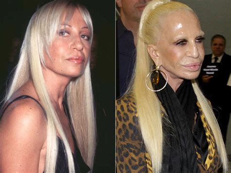 31 Plastic Surgery Gone Wrong Pictures That Will Make You Feel