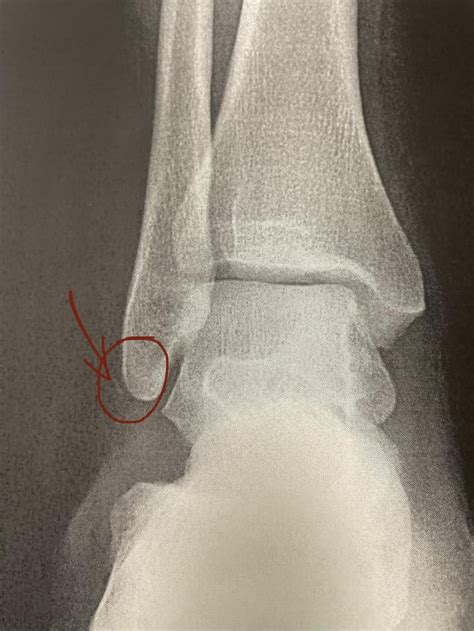 30 Year Streak Broken Rneverbrokeabone