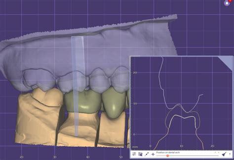 Radwa Ahmed On Linkedin Exocad 3shape Digitaldentaldesigner Cadcam