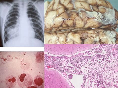 Pneumonia Classification And Etiology Ppt