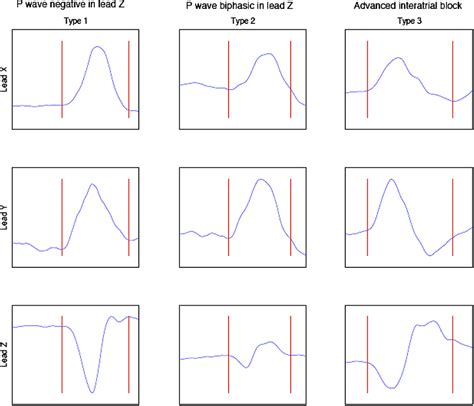Schematic Illustration Of The Pwave Morphology Classification Type 1 Download Scientific
