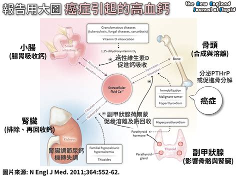 85 臨床藥學 癌症引起的高血鈣 Malignancy Induced Hypercalcemia 我的網頁