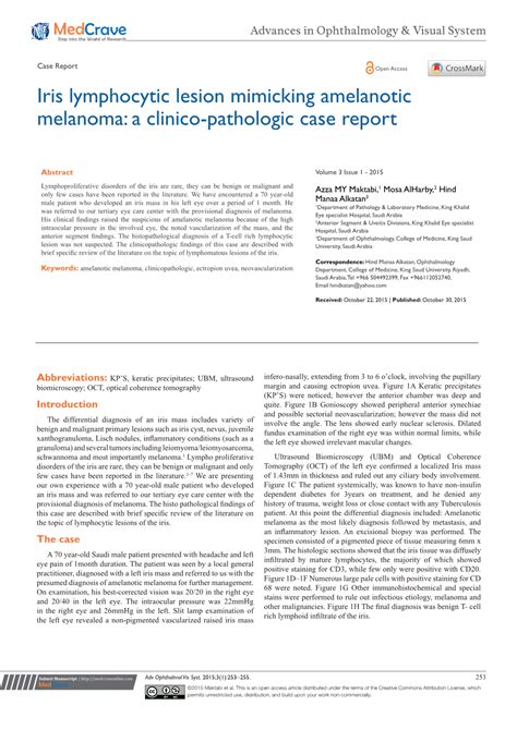 Iris Lymphocytic Lesion Mimicking Amelanotic Melanoma A Clinico