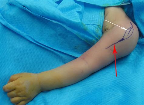 Photograph Of The Planning For Incisional Biopsy From The Proximal