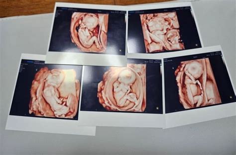 자연 임신으로 다섯쌍둥이 출산…국내 첫 사례 아시아경제