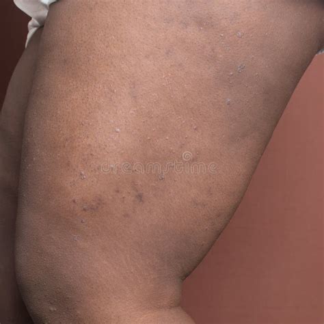Brown Skin With Hyperpigmentation And Scarring From Eczema And Atopic
